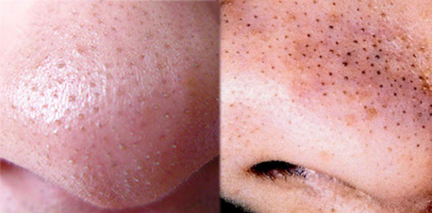 5 CARA JADIKAN HIDUNG HALUS BEBAS KOMEDO | KASKUS